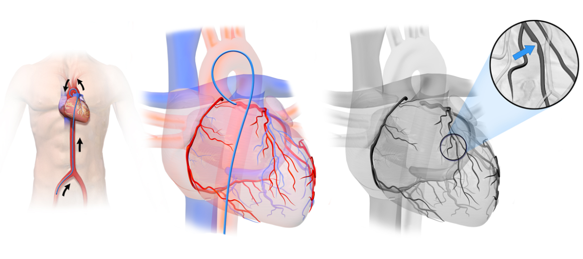 Cardiac Catheterization Diagnosing Heart Disease Central Georgia 