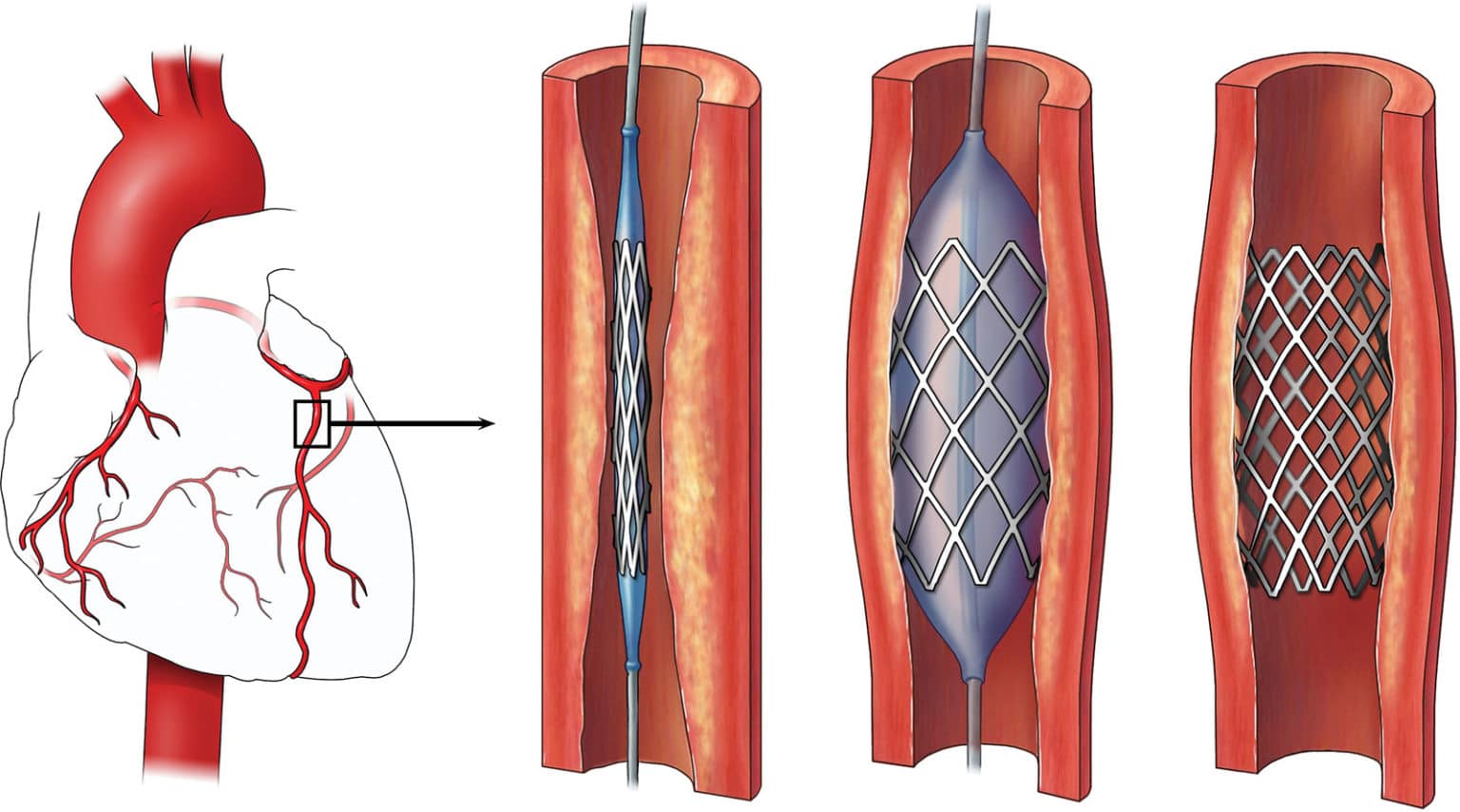 What You Need To Know About A Heart Stent - Central Georgia Heart Center
