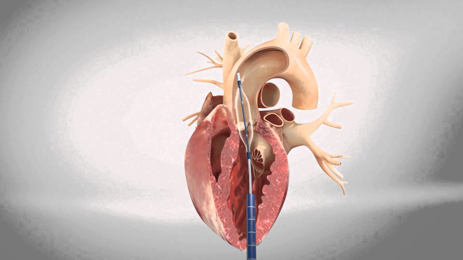 Undertsanding A Transcatheter Aortic Valve Replacement (TAVR) - Central ...
